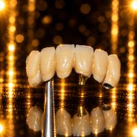 Quality Dental Lab Custom Implant Bridge — Implant Retained Porcelain Fused Metal Bridge for sale