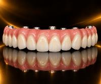 Quality ADL Dental Iaboratories limited | Class I AOX Implants All On 4 Hybrid Titanium for sale