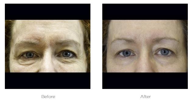 Elite Ultra 360_Before_and_After_photos_Eyes