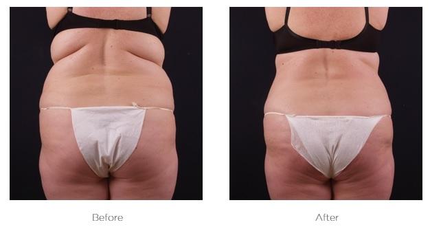 Elite Ultra 360_Before_and_AFter_Abdomen