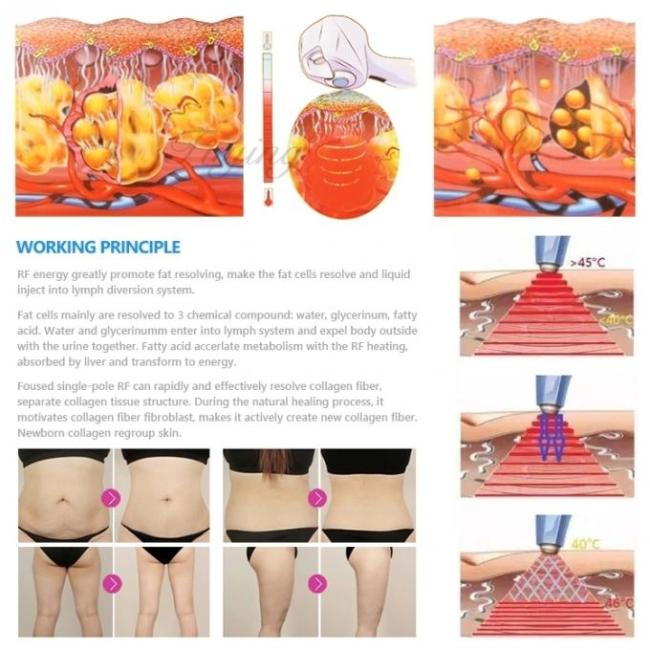 Elite Ultra 360 Elite Cellulite Reduction Focused RF Ultrasound Slimming Machine
