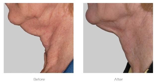 Elite Ultra 360_Before_and_After_Chin