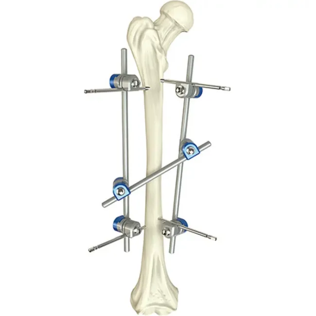 Quality Assured Basic Orthopedic Surgical Instrument Femoral Shaft External Fixator Medical Surgical Medical Instruments