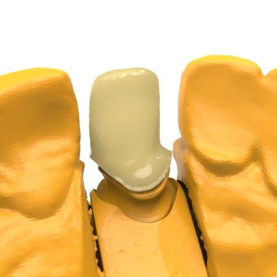 China Lightweight Permanent Crown Resin High Durability and Superior Mechanical Properties for sale