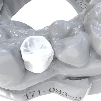 Cina Corone dentali Resina permanente Alta precisione per risultati superiori nel restauro della corona in vendita
