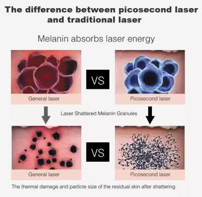 Cina Macchina 755nm 1064nm 1320nm del laser di picosecondo di rimozione del tatuaggio in vendita