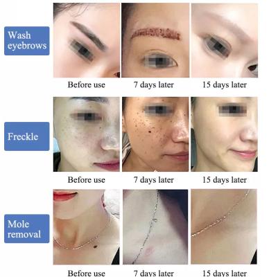 Cina Macchina 755nm 808nm del ND YAG Pico Laser Picosecond Tattoo Removal in vendita
