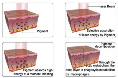 Cina 3 rimozione 2000W del tatuaggio della macchina del laser di picosecondo di lunghezza d'onda 1000mj 2000mj in vendita