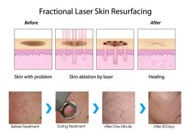 Cina Ultra rifare la superficie frazionario del laser di CO2 della macchina 10600nm del laser di CO2 di impulso in vendita