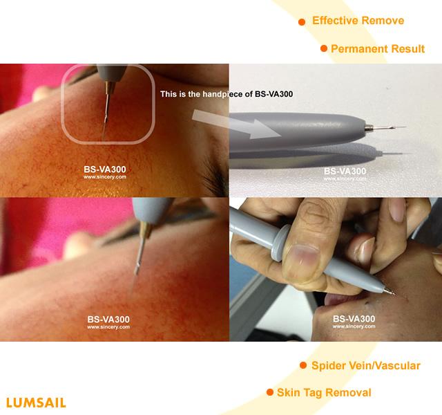 rimozione vascolare