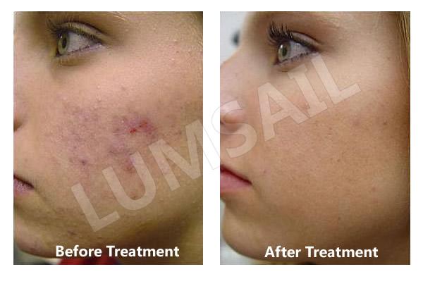 acne_before_after_4.jpg