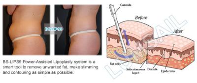 Cina Il potere di contorno del corpo ha assistito l'attrezzatura della liposuzione per il corpo che scolpisce i trattamenti in vendita