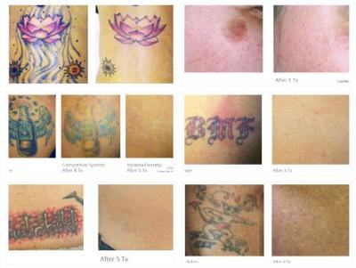 Cina Alta macchina del laser del ND YAG del commutatore della macchina Q del laser di Pico di potenza di picco per il tatuaggio/la depilazione in vendita