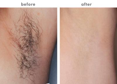 China Salon 808nm Laser Hair Removal Device With Efficient Skin Cooling System for sale