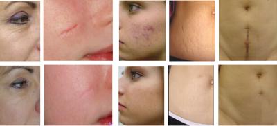 Cina Tipo verticale trattamento frazionario del braccio flessibile lungo del laser di CO2 per le cicatrici dell'acne in vendita