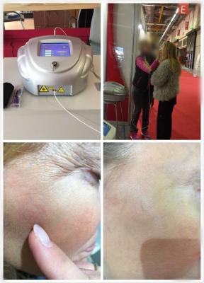 Cina Attrezzatura Pulser portatile di terapia laser, macchina di rimozione della vena del ragno 980nm in vendita