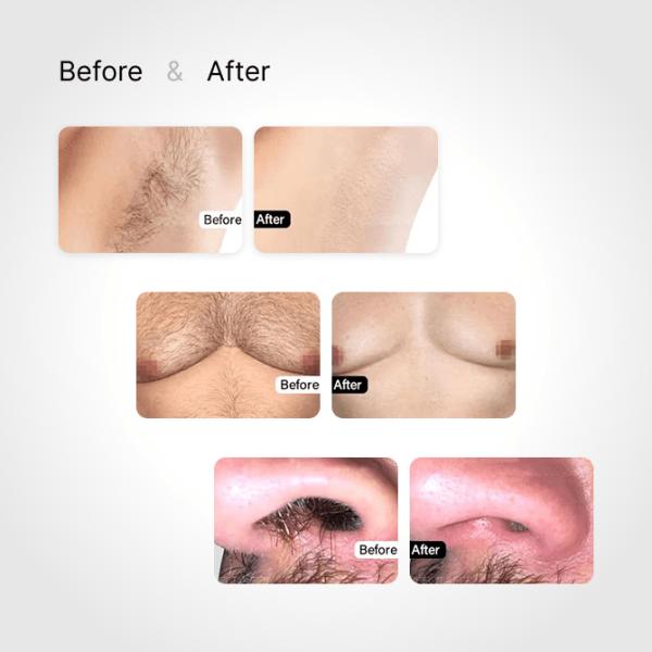 Quality Diode laser hair removal for sale