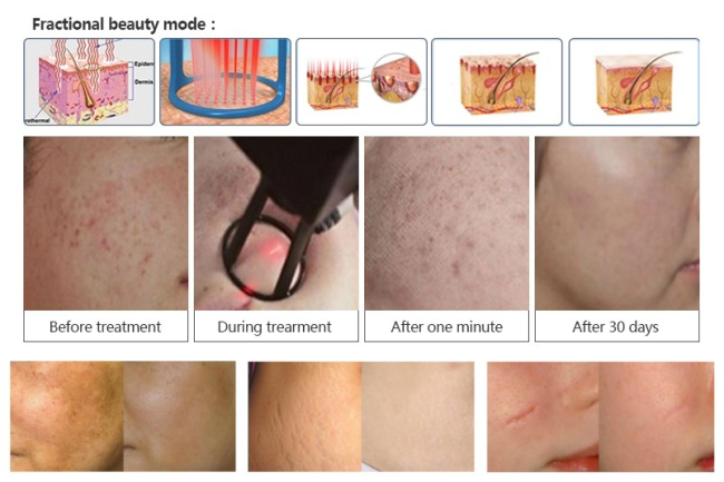 Co2 fractional Laser Skin Rejuvenation and vagina tighten Equipment for salon and clinic