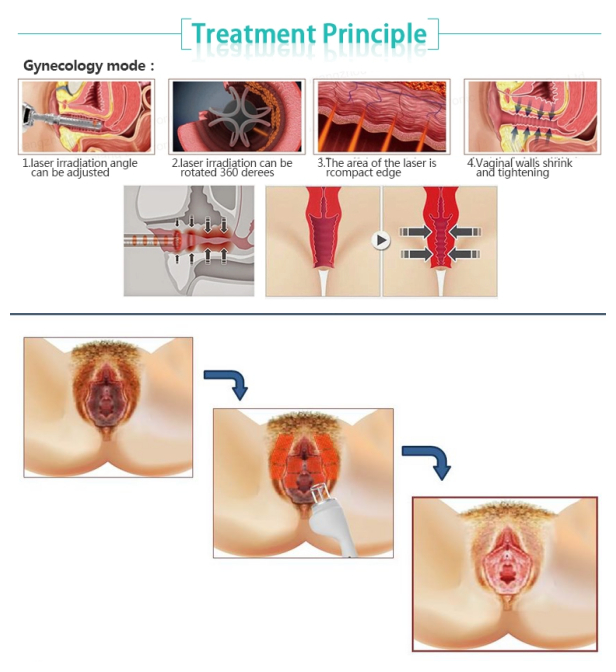Co2 fractional Laser Skin Rejuvenation and vagina tighten Equipment for salon and clinic