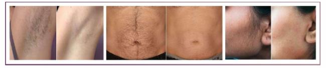 Diode laser treatment