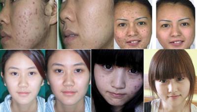 Cina depilazione della macchina di rimozione dell'acne di 1200W IPL con 3 filtri differenti in vendita