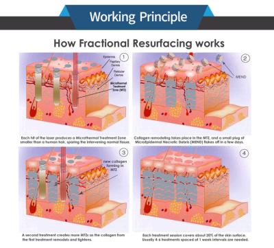 Cina Nuovo rilasciato Fractional Co2 + Ultra Pulse + Vaginal Laser Scar Removal Machine in vendita