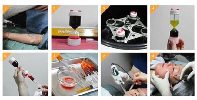 XL6A Portable Medical Grade PRP Centrifuge Machine for Whitening, Rejuvenation, and PRP Facial 1
