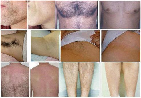 Depilazione professionale stazionaria 1 di terapia laser del diodo dell'attrezzatura/macchina 810nm di bellezza