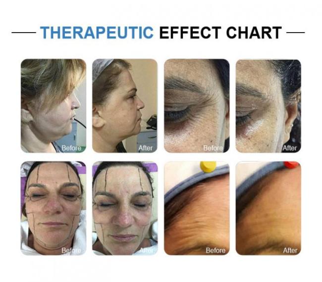 HONKON HIFU Machine Facial Wrinkle Removal High Intensity Focused Ultrasound 1