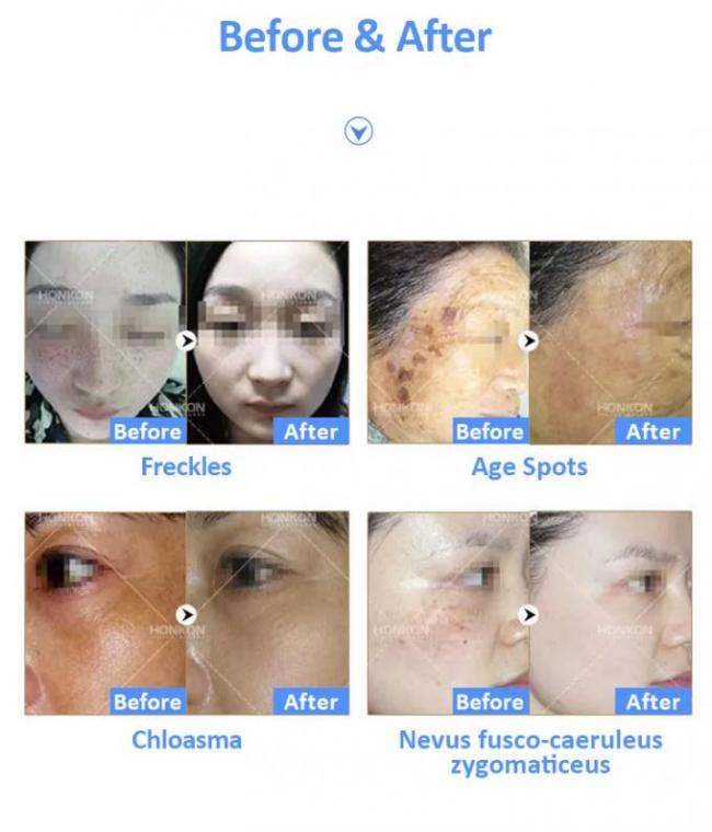 Picosecond Laser Beauty Machines For Pigmentation Lesions Treatment Tattoo Removal 2