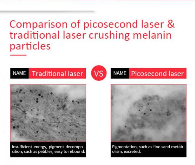 900ps Powerful Picosecond Laser For Tattoo Removal High Homogeneous Spot Mode 1