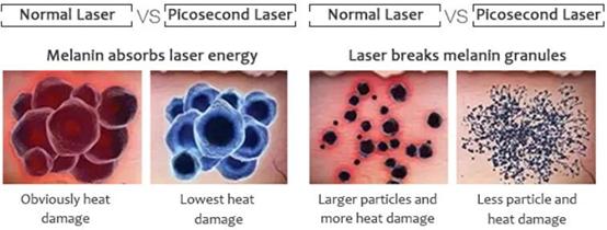 Uniform Spot 1064nm Pigmentation Removal and professional tattoo removal Picosecond Laser Equipment 1