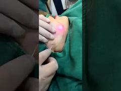 La machine de réduction de graisse laser à diode 1470nm professionnelle donne des résultats visibles en 2-3 séances