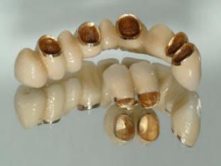 China dental Captek crown for sale