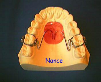 China dental nance appliance for sale