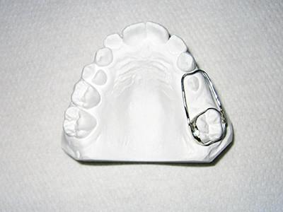 China dental space retainer for sale