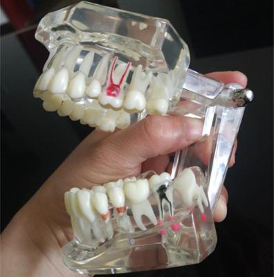 Cina I denti patologici di attività smontabile dei materiali dentari modellano in vendita