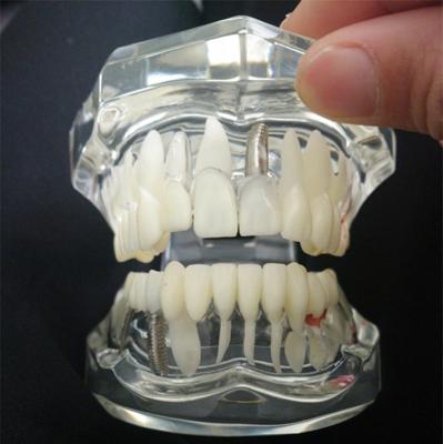 Cina I denti patologici di attività smontabile dei materiali dentari modellano in vendita