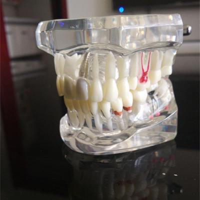 Cina I denti patologici di attività smontabile dei materiali dentari modellano in vendita