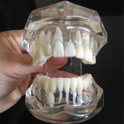 Cina I denti patologici di attività smontabile dei materiali dentari modellano in vendita