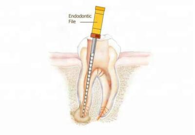 Cina Indicatore di posizione dentario dell'apice di Niti Endo Rotary Files Barbed Broaches del motore in vendita