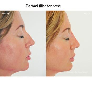 China skin care injectable 1ml 2ml hyaluronic acid gel for beauty salon for sale