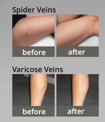 China Free shipping!! blood vessels removal/portable spider vein removal machine for sale