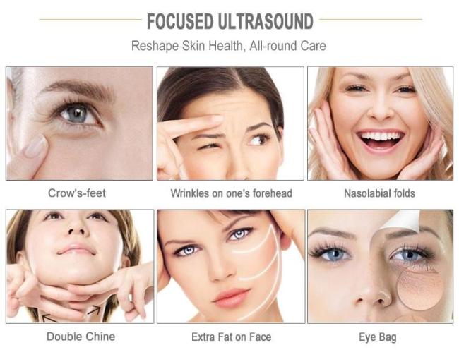 Aperto da pele do IPL | Resgatar MediSpa Brampton & Vaughan