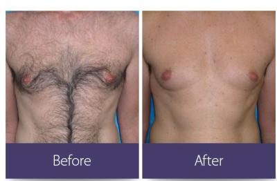 China 2022Newest 4K 1600W Triple wave Platinum Titanium/808nm laser diode hair removal/755 8081064 diode laser machine price for sale