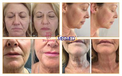 중국 7D 12D 14D ICE HIFU 얼굴 리프팅 주름 제거 HIFU 기계 판매용