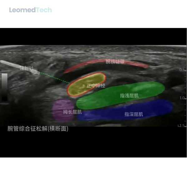 Quality AI‑Powered Ultrasound Software for Diagnostic Analysis and Surgical Guidance for sale