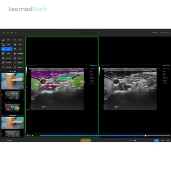 Quality AI‑Powered Ultrasound Software for Diagnostic Analysis and Surgical Guidance for sale
