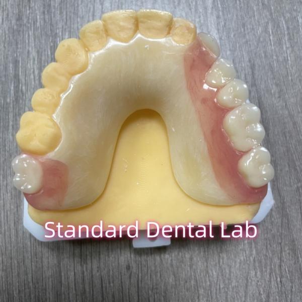 Quality OEM Removable Cast Tooth Shade Acrylic Partial Denture With Clasps for sale