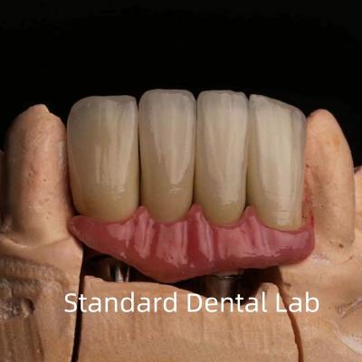 Cina Dental Porcellana Zirconia Impianto Corona Professionale Alta Estetica in vendita